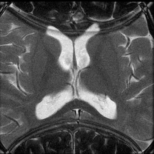 アーチファクト | 診療放射線技師国家試験 対策ノート